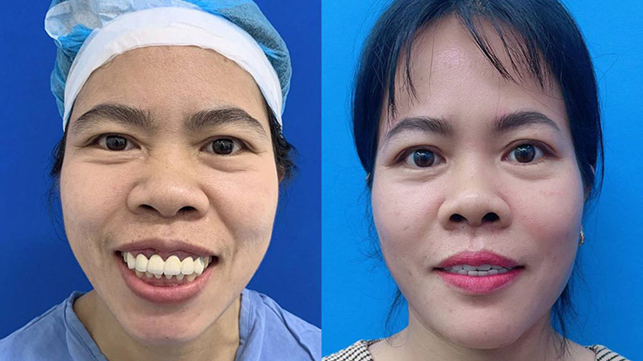 Jaw Surgery for Protruding or Retruded Jaw: A Solution for a Balanced ...